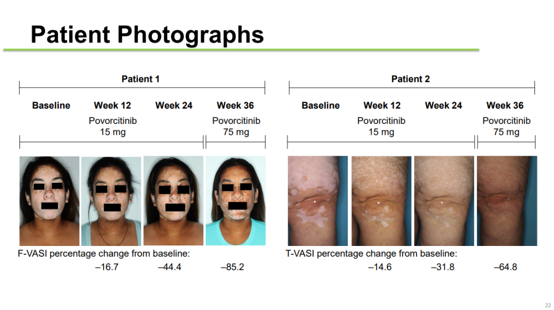 Incyte口服JAK1抑制剂治疗白癜风IIb期研究成功医药新闻-ByDrug-一站式医药资源共享中心-医药魔方
