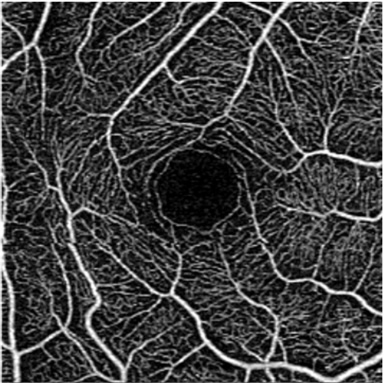 OCTA报告解读 | 教你层层分析识病变医药新闻-ByDrug-一站式医药资源共享中心-医药魔方