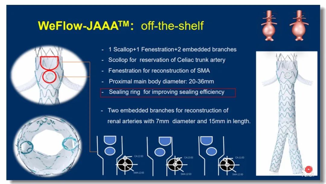 【微动态】郭伟教授近期发布WeFlow-JAAA覆膜支架系统治疗近肾腹主动脉瘤的安全性和有效性医药新闻-ByDrug-一站式医药资源共享中心-医药魔方