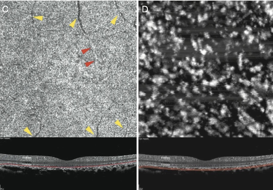 OCTA报告解读 | 教你层层分析识病变医药新闻-ByDrug-一站式医药资源共享中心-医药魔方