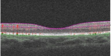 OCTA报告解读 | 教你层层分析识病变医药新闻-ByDrug-一站式医药资源共享中心-医药魔方