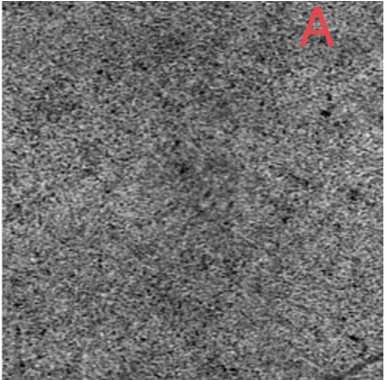 OCTA报告解读 | 教你层层分析识病变医药新闻-ByDrug-一站式医药资源共享中心-医药魔方