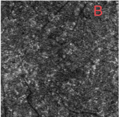 OCTA报告解读 | 教你层层分析识病变医药新闻-ByDrug-一站式医药资源共享中心-医药魔方