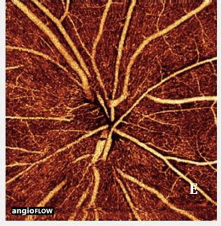 OCTA报告解读 | 教你层层分析识病变医药新闻-ByDrug-一站式医药资源共享中心-医药魔方