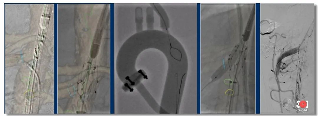 【微动态】郭伟教授近期发布WeFlow-JAAA覆膜支架系统治疗近肾腹主动脉瘤的安全性和有效性医药新闻-ByDrug-一站式医药资源共享中心-医药魔方