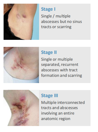 IFRX官宣：全球韦洛利单抗临床进展情况医药新闻-ByDrug-一站式医药资源共享中心-医药魔方