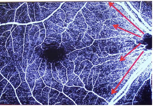 OCTA报告解读 | 教你层层分析识病变医药新闻-ByDrug-一站式医药资源共享中心-医药魔方