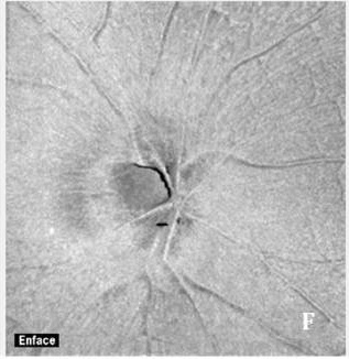 OCTA报告解读 | 教你层层分析识病变医药新闻-ByDrug-一站式医药资源共享中心-医药魔方