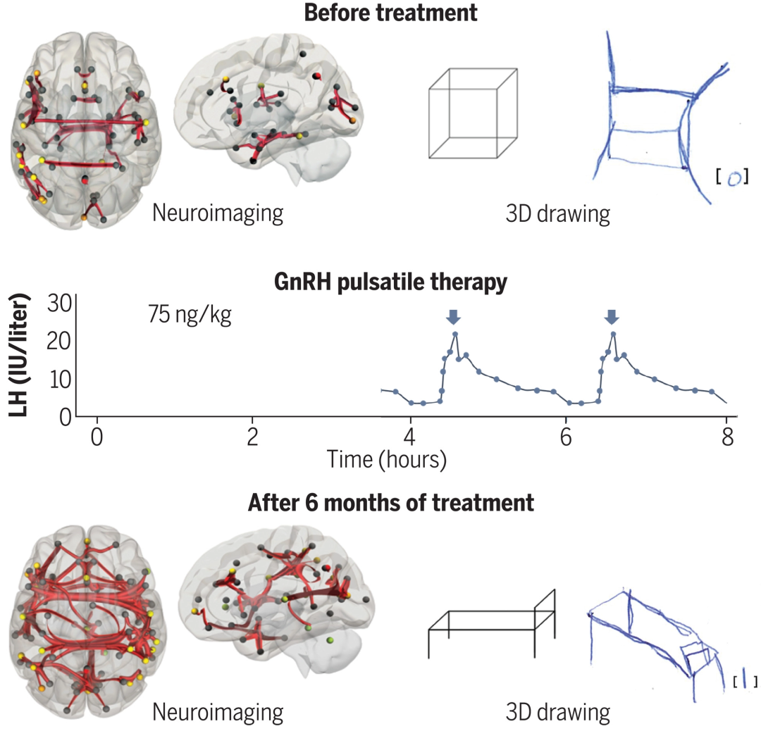 Science：GnRH注射疗法可改善唐氏综合征患者认知功能医药新闻-ByDrug-一站式医药资源共享中心-医药魔方