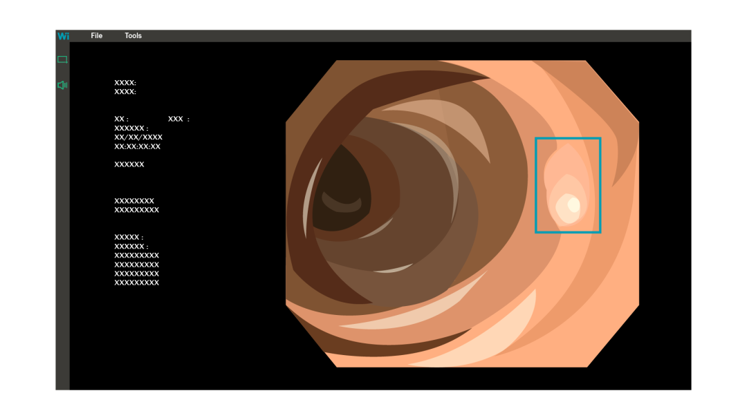 微识医疗获批NMPA首张实时动态影像AI产品三类证，创新医疗器械首个消化内镜AI产品医药新闻-ByDrug-一站式医药资源共享中心-医药魔方